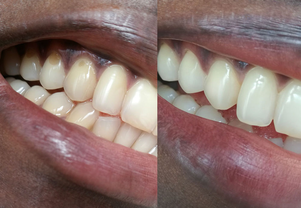 SUCCESSFUL TEETH REMINERALIZATION
