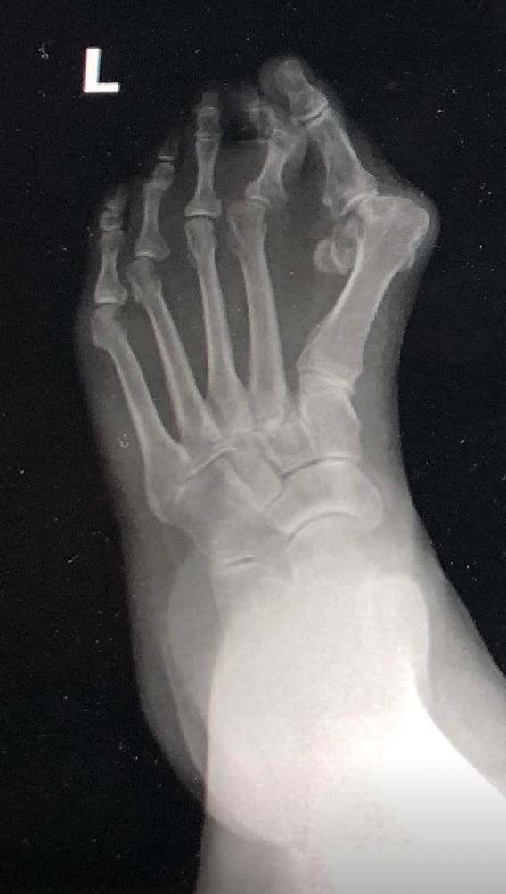 metatarsus adductus in adults