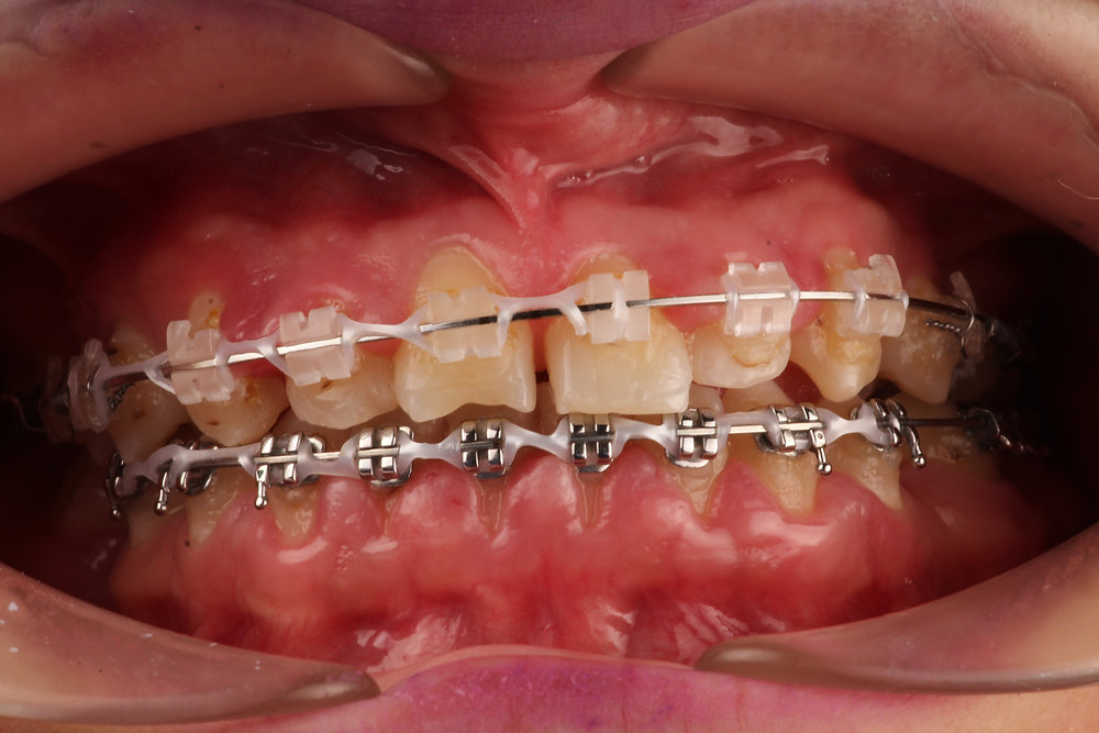 Higiene de un paciente con Brackets