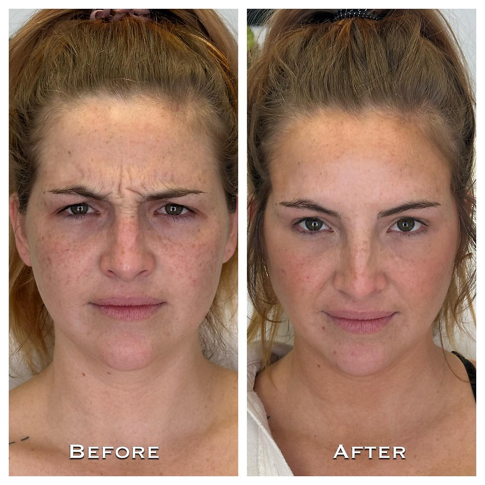 Understanding Botox for 11 Lines: What You Need to Know