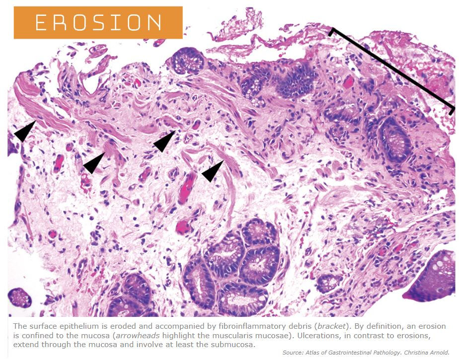 Esophageal Erosion vs. Ulceration? How can you tell a difference