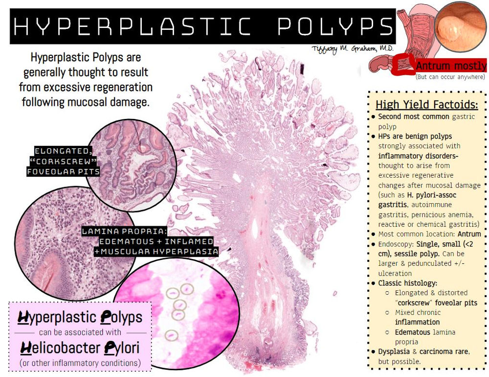 Hyperplastic Polyp