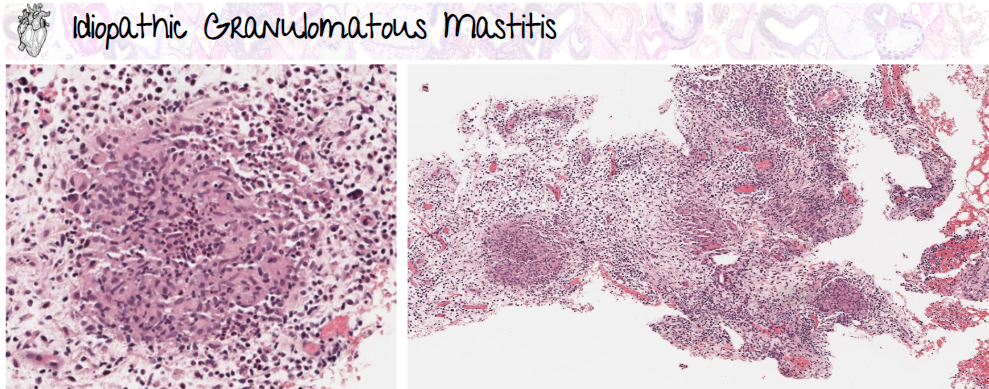 Breast Pathology | iheartpathology