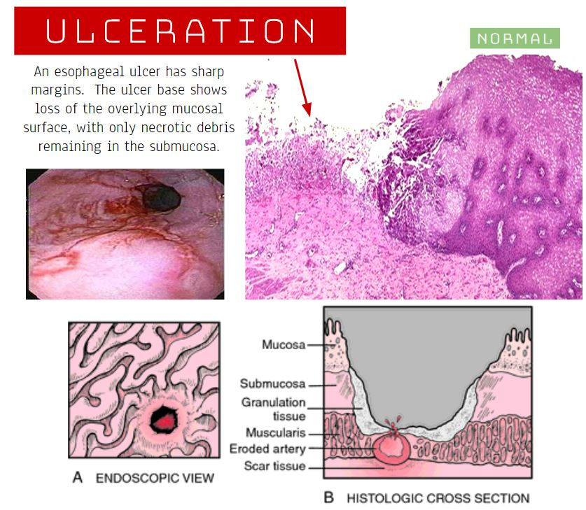 Esophageal Erosion vs. Ulceration? How can you tell a difference