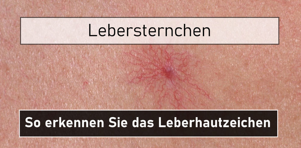 Lebersternchen: So erkennen Sie das Leberhautzeichen!