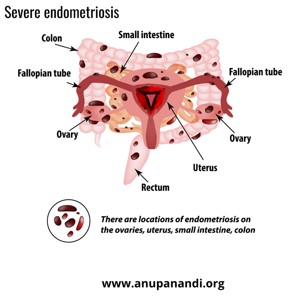 Can Endometriosis cause infertility?