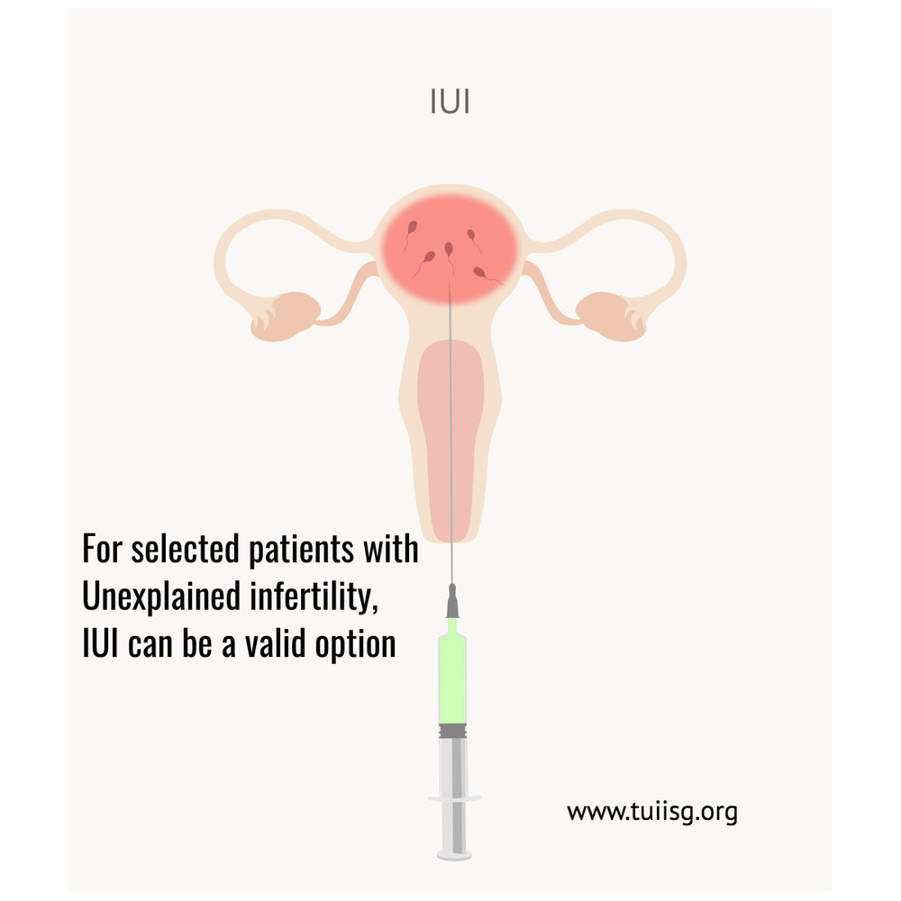 IUI for Unexplained infertility