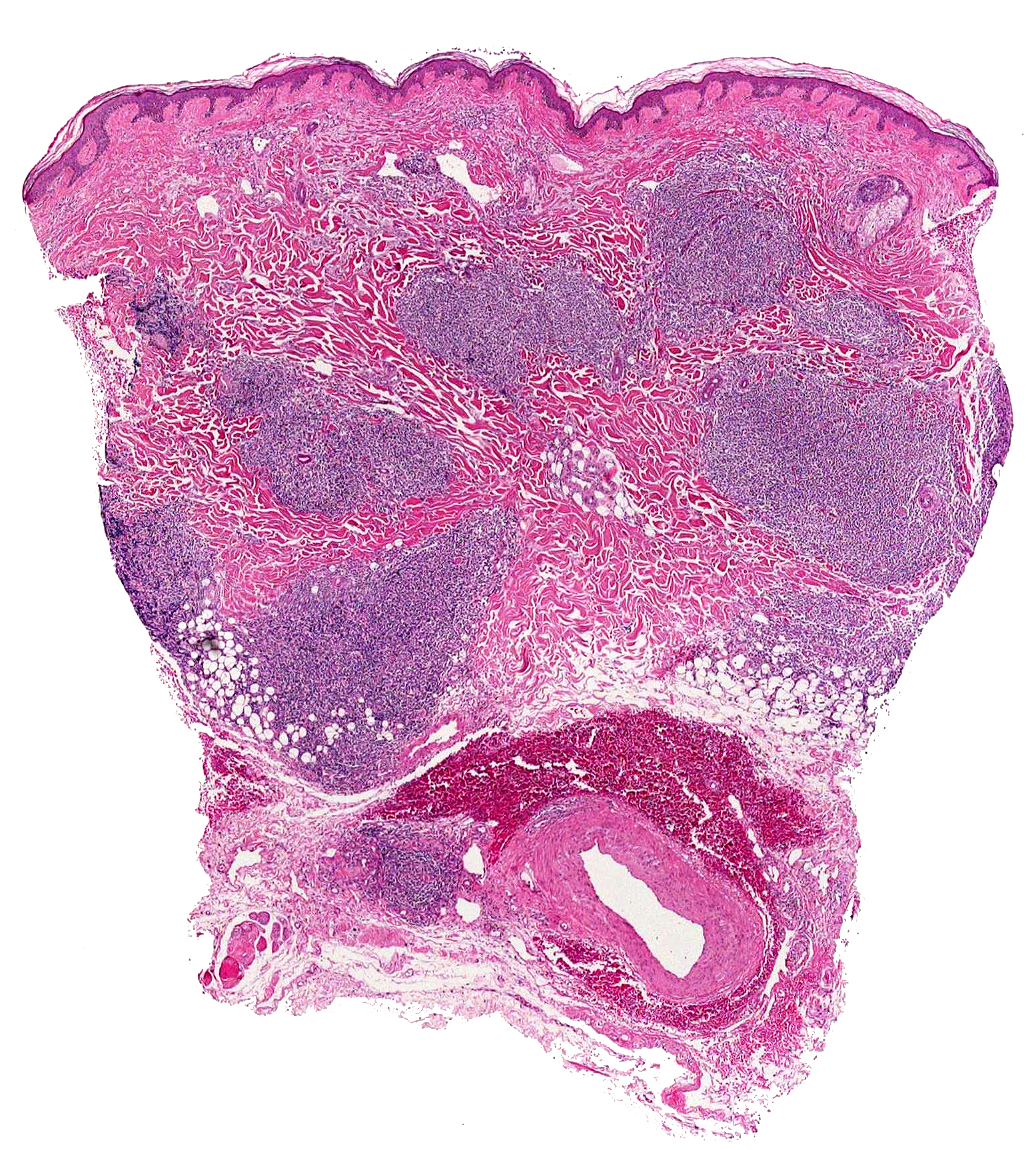 Impetigo Bolhoso Na Virilha - RETOEDU