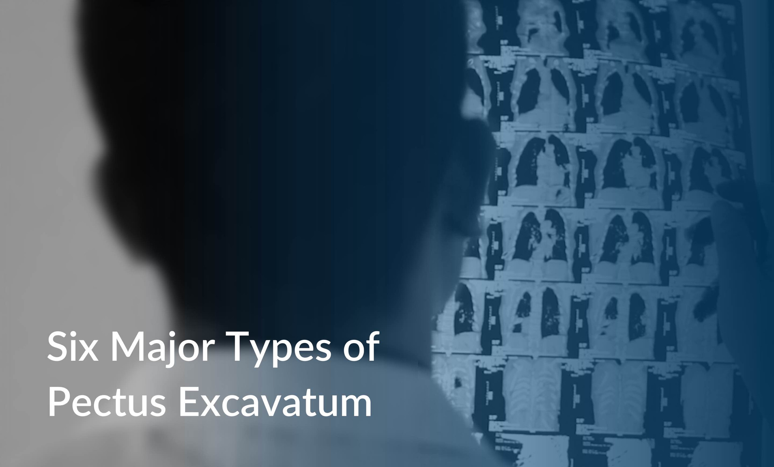 Six major types of pectus excavatum