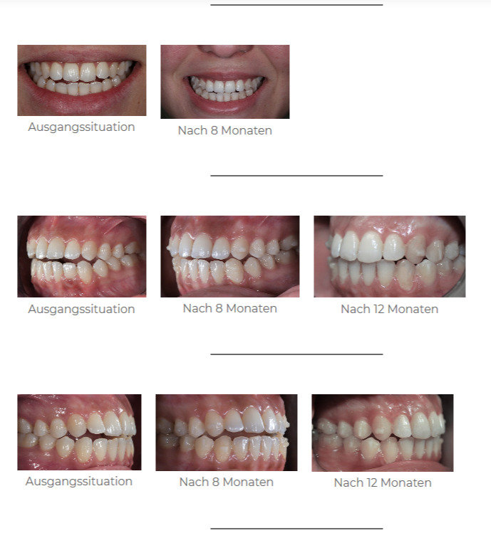 Offener Biss: K Clear Fallstudie