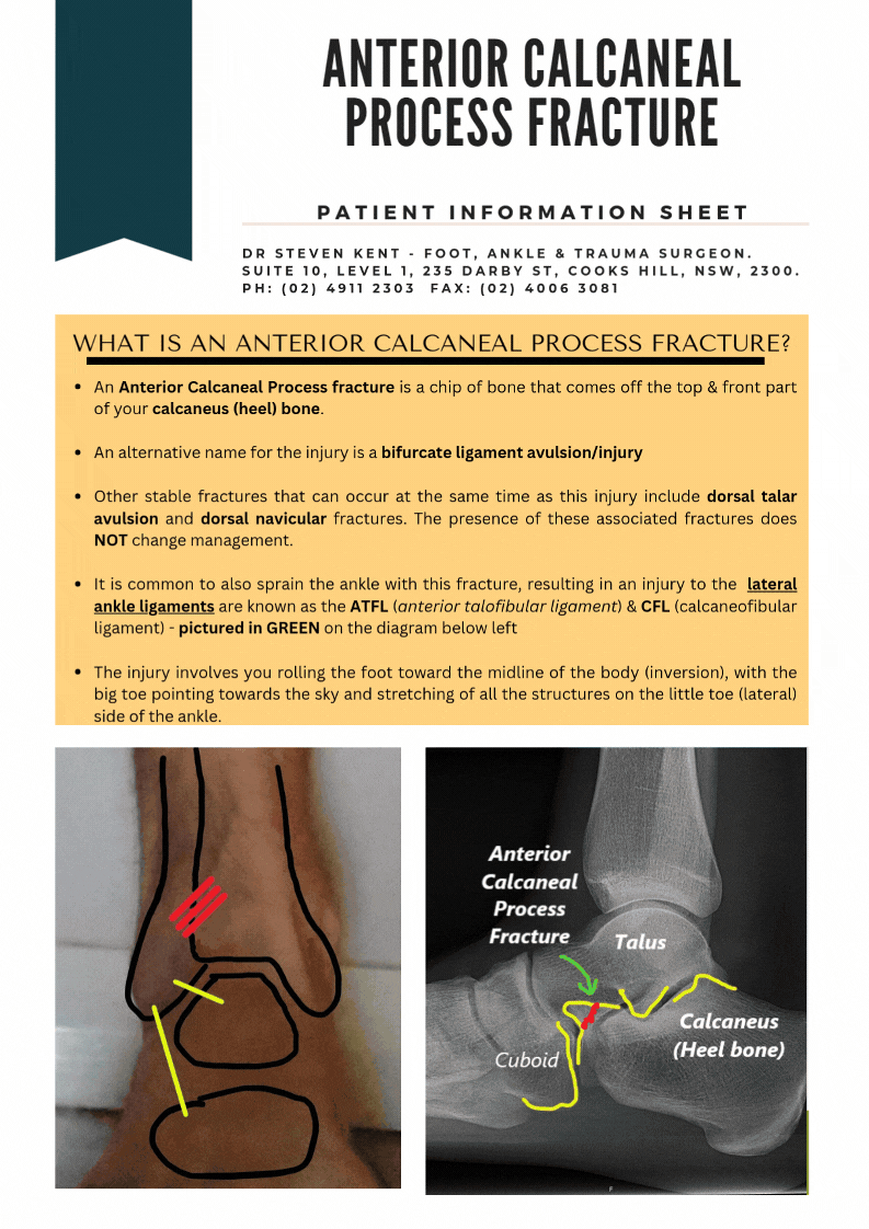 Debuting Our New Anterior Calcaneal Process Fracture Patient ...