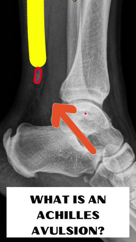 What is An Achilles Tendon Avulsion?