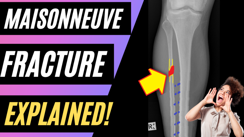What is a MAISONNEUVE FRACTURE?