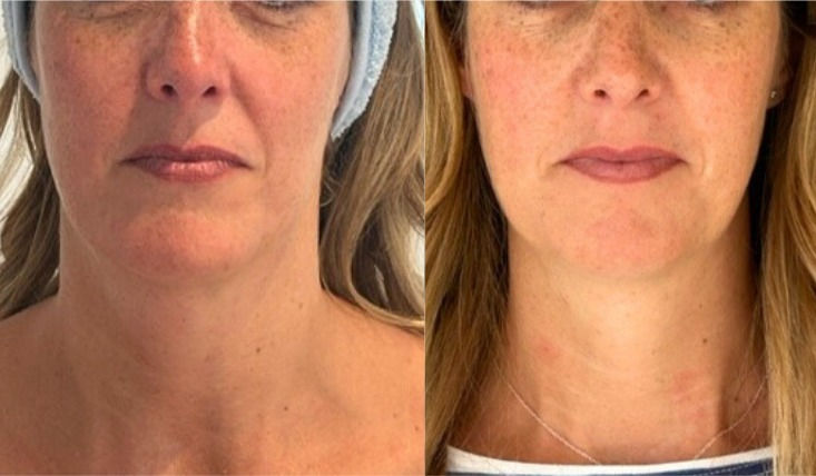 Dermal Fillers & Skin Boosters | Cheltenham & Cirencester
