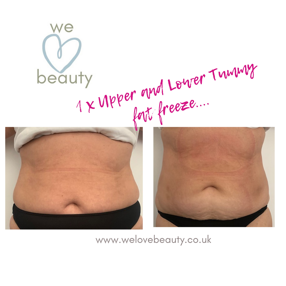 fat freezing gloucester