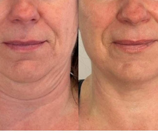 Fat Dissolving Injections | Body & Face Clinic