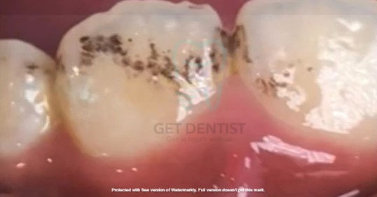 Mengenal Stain Yang Terdapat Pada Gigi