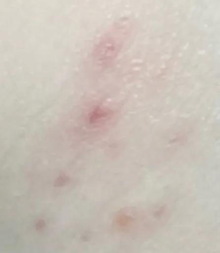 Molluscum Contagiosum Stages with Pictures