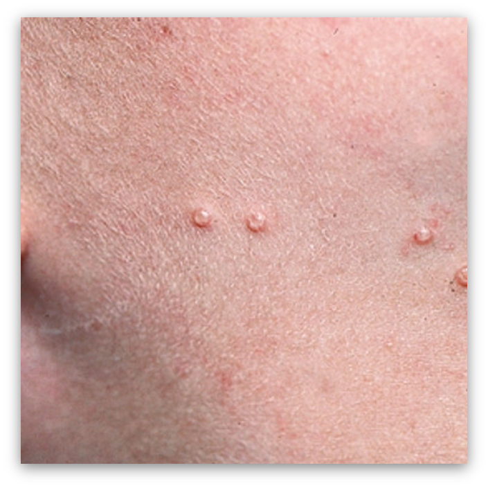 Molluscum Patches | Hydrocolloid Patches - Skin Bump Gone