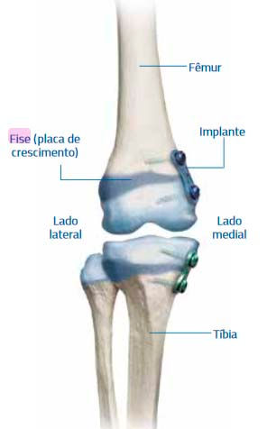 Crescimento Guiado - Guided Growth Surgery