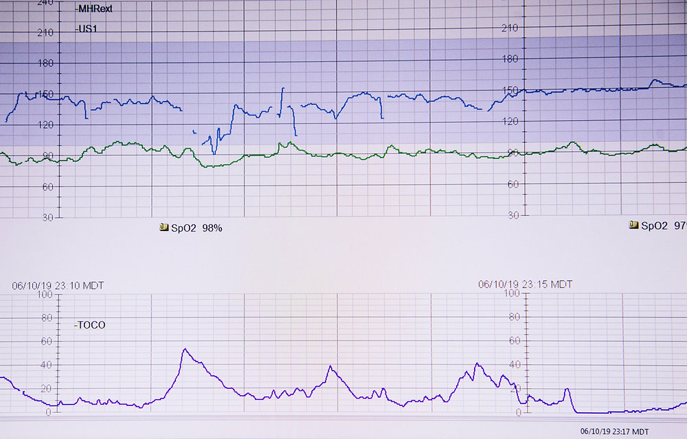 A short guide on how Cardiotocography (CTG) is used in fetal monitoring