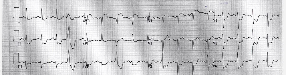 The Clinical significance of ST Elevation in limb lead (aVR)
