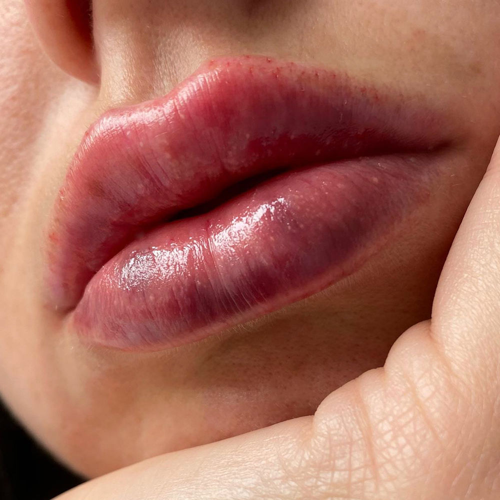 Filler labbra: evoluzione nel tempo?