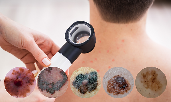 Skin Checks | ReCreation Medical Centre