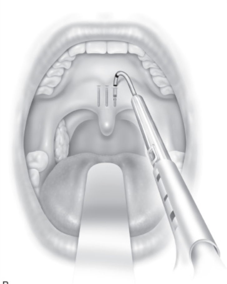 EVOLUTION OF SOFT PALATE SURGERY