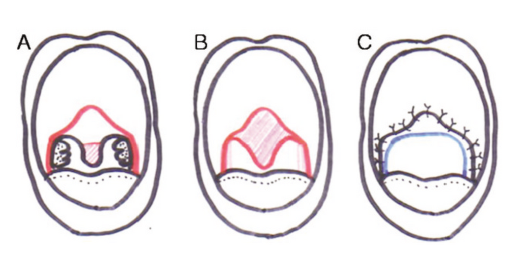 EVOLUTION OF SOFT PALATE SURGERY