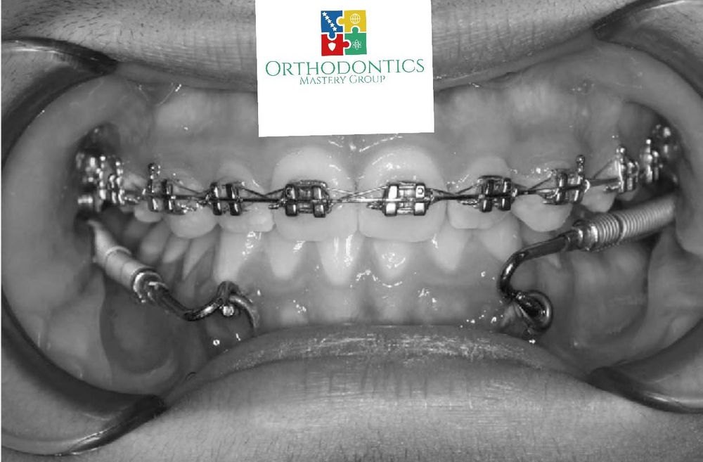 Effectiveness of miniscrew supported fixed functional appliance (MSFFA)