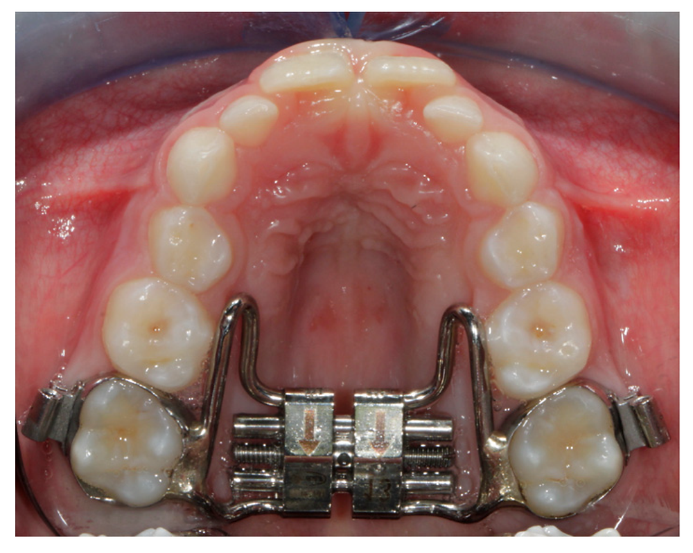 Revise and Review: Retention After Rapid Maxillary Expansion (RME)