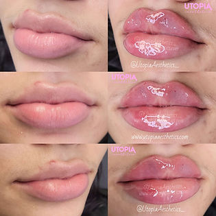 LIPS GALLERY | Utopia Aesthetics