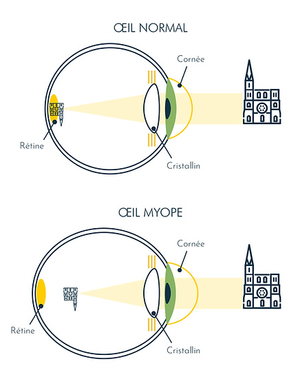 Opération de la myopie au laser à Strasbourg | Expert Vision Center