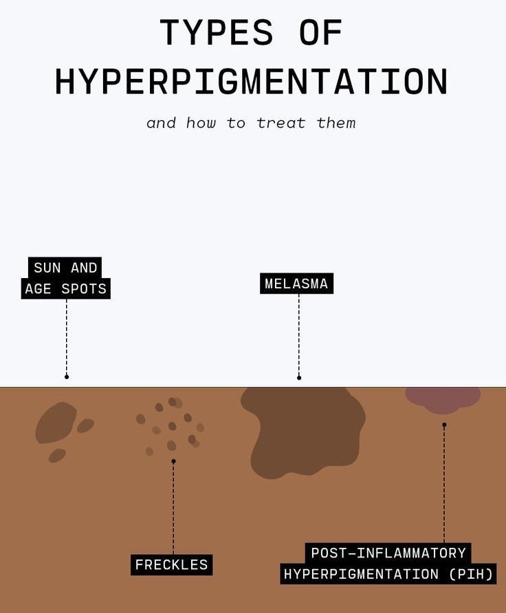 How to treat hyperpigmentation