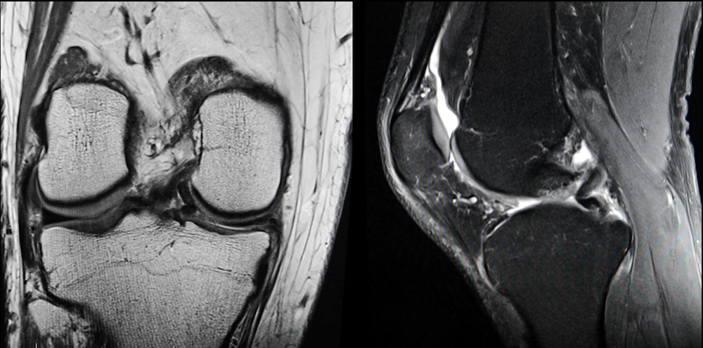 Meniscus Injuries Part 2 - Diagnosis & Acute The Stage