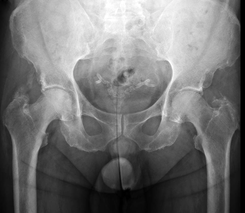 OSTEOARTHRITIS OF THE HIP AND KNEE – PART 1