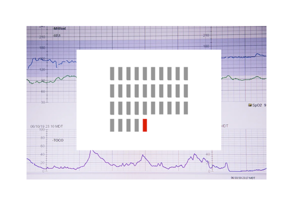 Alarmierend: 1 von 35 Geboosterten hat Laborwerte, die auf akute ...