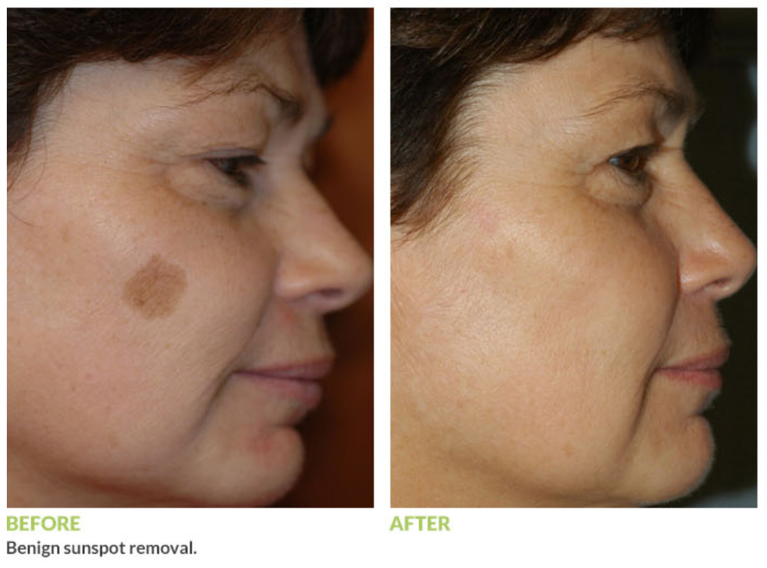 GentleMax Pro sunspot before and after