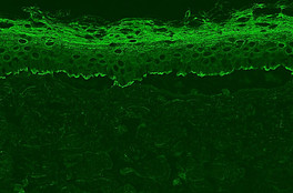 Diagnostiek| Auto-immuun blaarziekten| Laboratorium Immunodermatologie