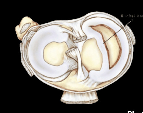 Diagnostic arthroscopy or menisectomy | Dr Sachin Jain Ortho