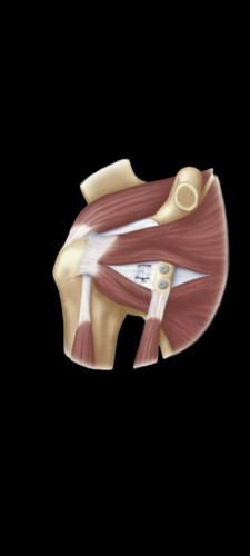 Latarjet procedure for shoulder dislocation | Dr Sachin Jain Ortho