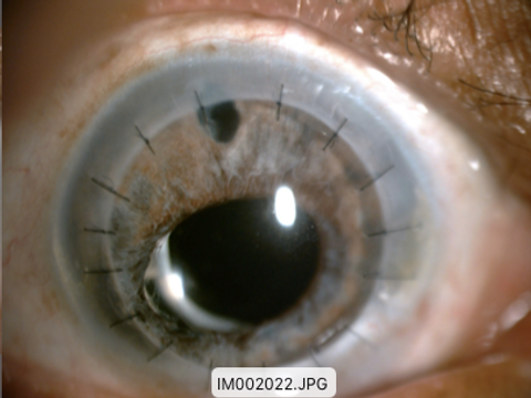 cornea surgeon surat, keratoconus, C3R, crosslinking, dry eye