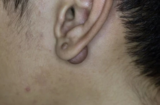 EAR KELOID EXCISION | Park Dermatology