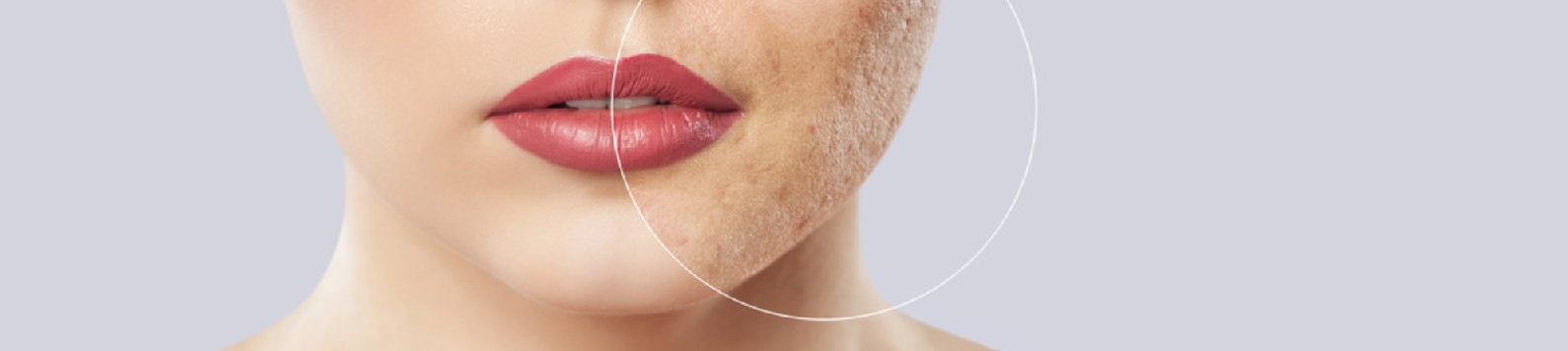 ACNE SCARS ON THE FACE