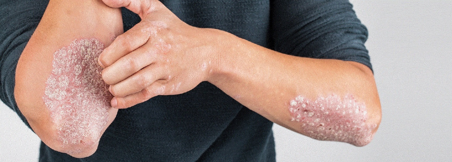 PSORIASIS: SKIN & JOINTS