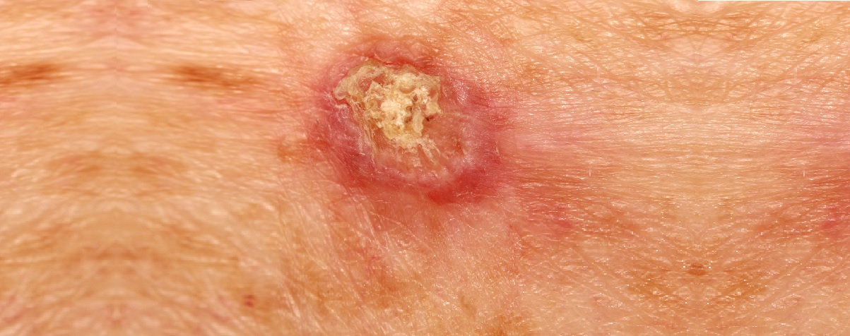 SQUAMOUS CELL CARCINOMA
