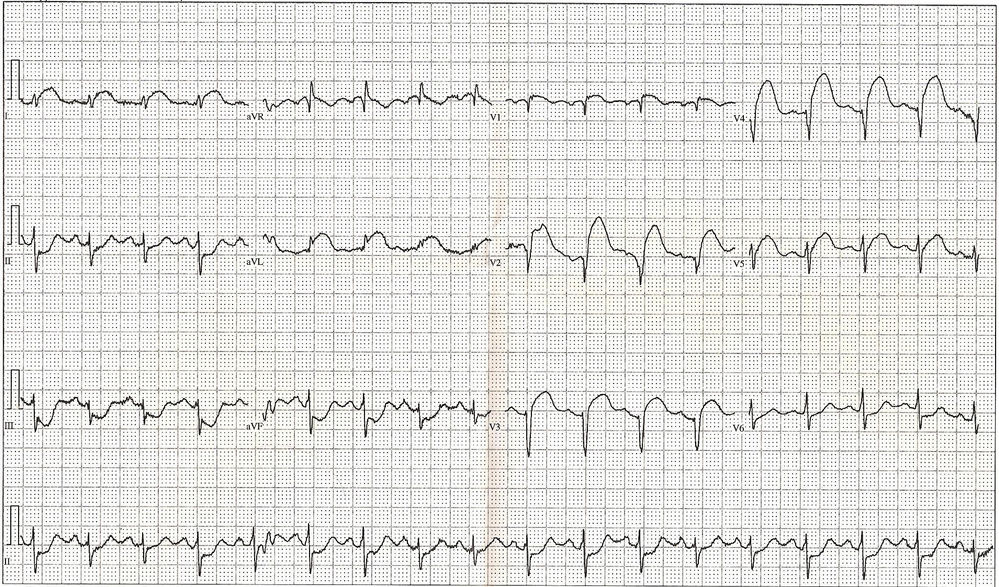 Infarto Agudo de Miocardio con Elevación del segmento ST ( STEMI)