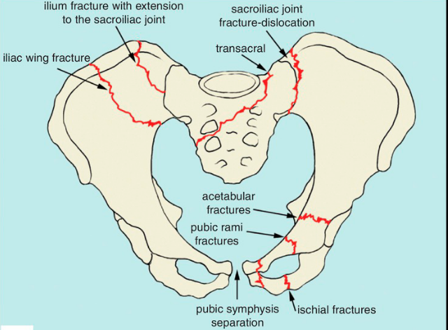 Fracturas de la Pelvis