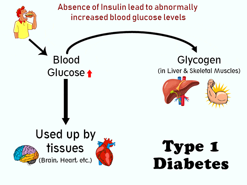 Diabetes – can it lead to hypoglycemia?
